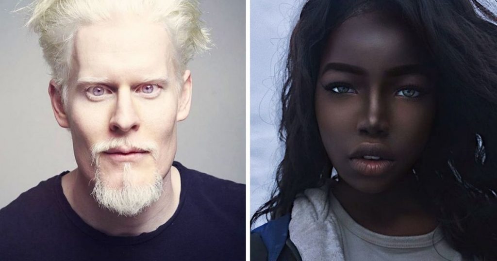 8 Charming People With a Unique Skin Color | Vicious Kangaroo